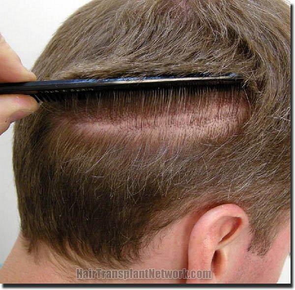 Dr. Robert True Hair transplant surgery before and after photos