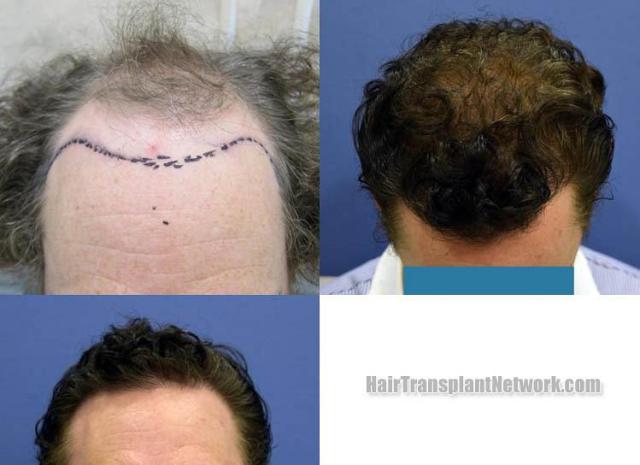 Dr Timothy Carman Hair Loss Replacement Surgery Before And After