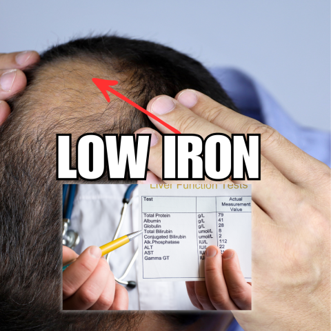 News: Can Low Iron Cause Hair Loss?